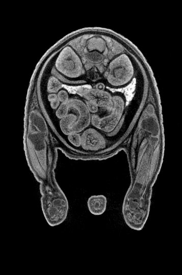 Mouse study identifies new target for human accelerated aging syndrome ...